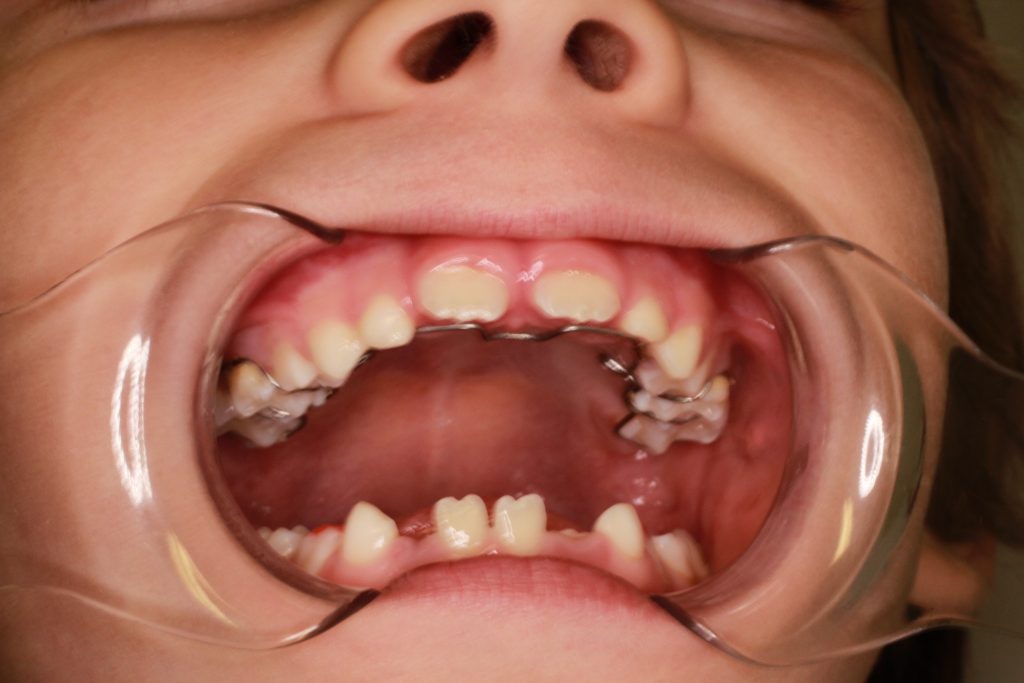 ALF Appliance in Children and Adults – Judith Dember Paige