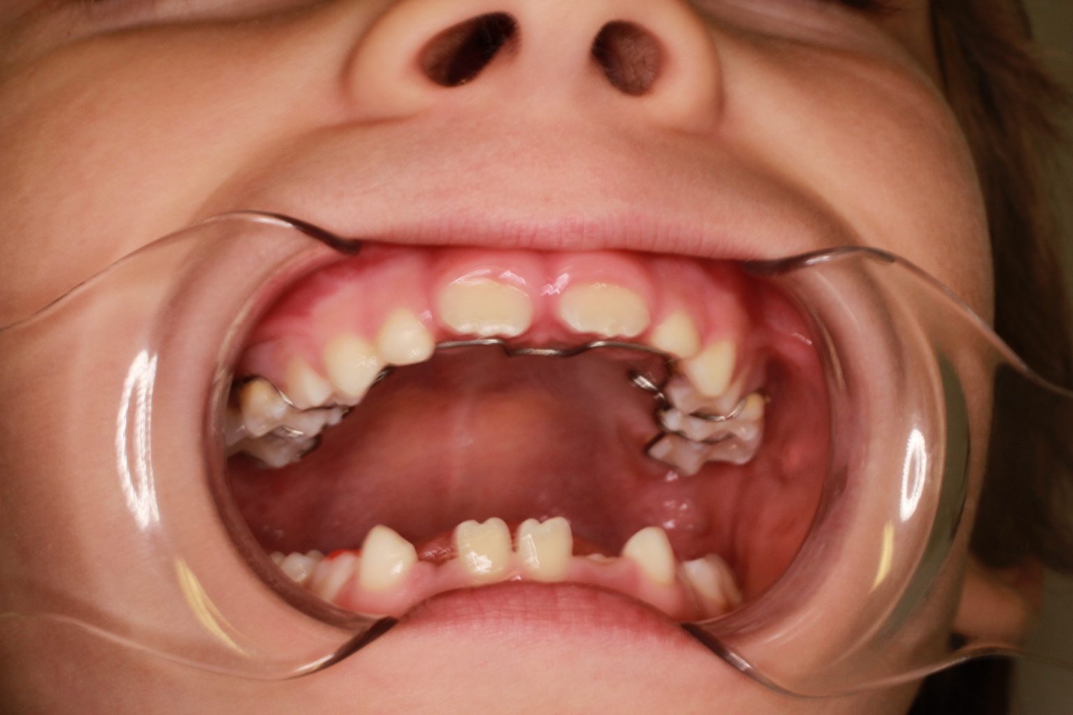 ALF Appliance in Children and Adults – Judith Dember Paige