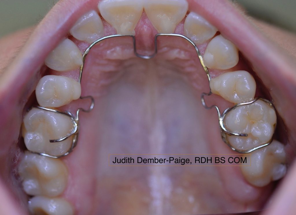 ALF Appliance in Children and Adults – Judith Dember Paige